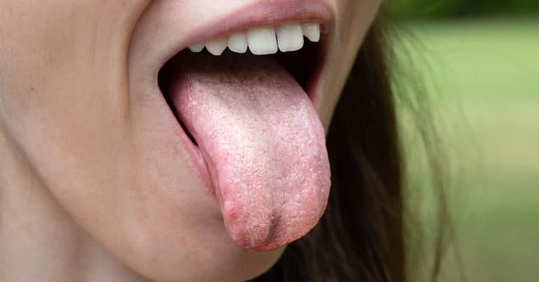 Types Of Candida infections (And How To Treat Them) – The Candida Diet